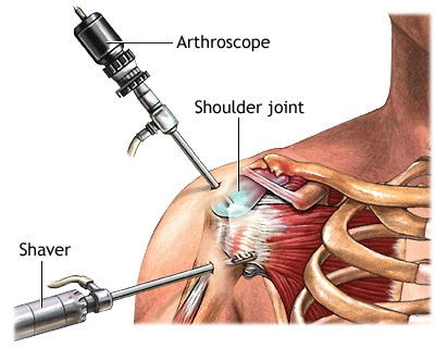 Minimally Invasive Shoulder Surgery in Seattle | Dr. Samuel Koo